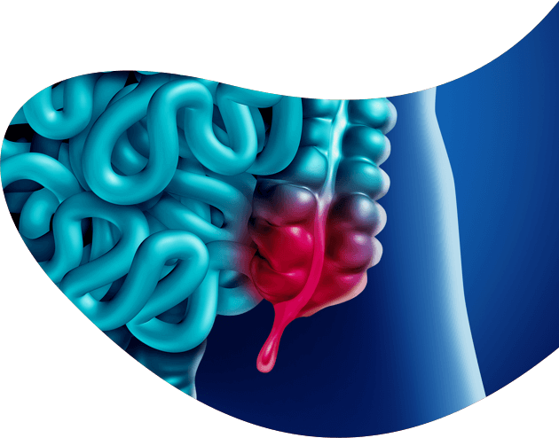 Appendix Surgery in Gurgaon, Delhi NCR | Appendicitis Treatment