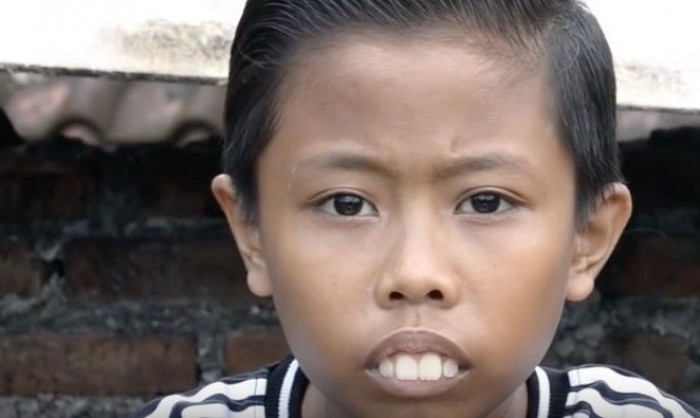 Gigi Tonggos Penyebab Dan Cara Memperbaiki